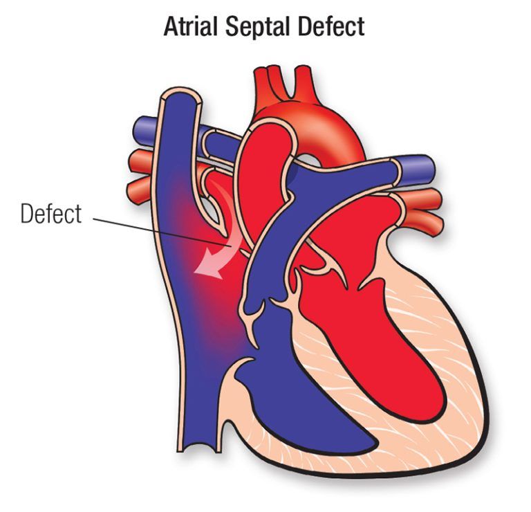 Types of CHDs-Atrial Septal Defect - Emerson Rose Heart Foundation